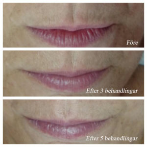 NBE 3000 - Ingers Spabehandlingar